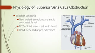 Superior Vena Cava Syndrome | PPTX