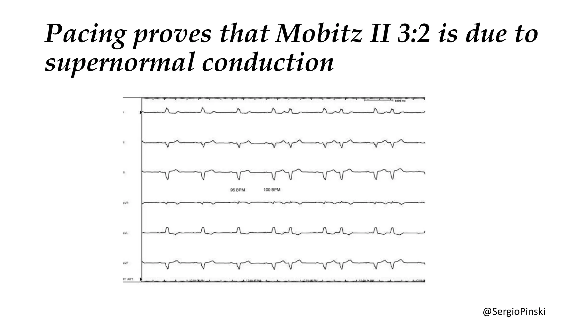 A thorough review of supernormal conduction.pptx | Free Download