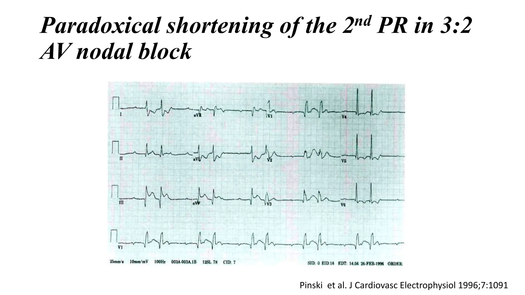 A thorough review of supernormal conduction.pptx | Free Download