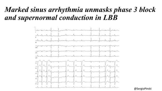 A thorough review of supernormal conduction.pptx | Free Download