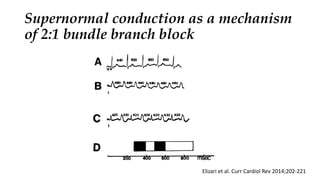 A thorough review of supernormal conduction.pptx | Free Download