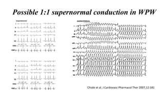 A thorough review of supernormal conduction.pptx
