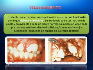 Supernumerarios Y Mesiodens2 | PPTX