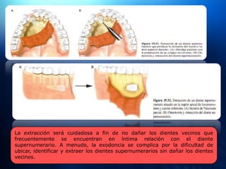 Supernumerarios Y Mesiodens2 | PPTX