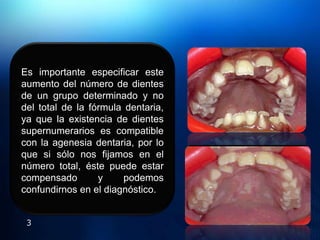 Supernumerarios Y Mesiodens2 | PPTX