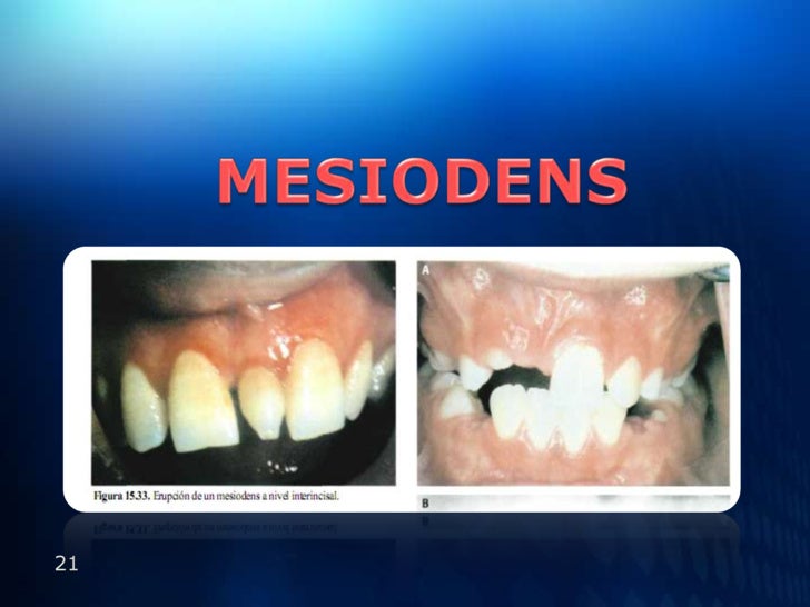Supernumerarios Y Mesiodens2