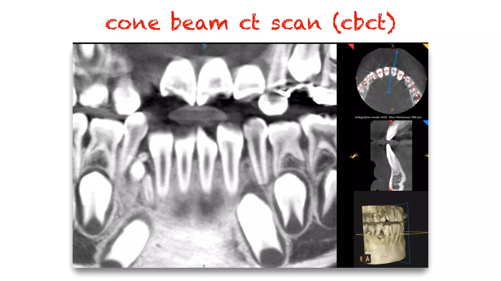 Diagnosis and Surgical Removal of Supernumerary Teeth In a 7-Year Old ...
