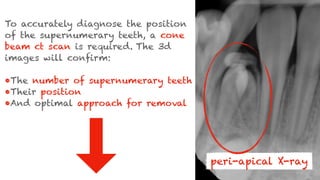 Diagnosis and Surgical Removal of Supernumerary Teeth In a 7-Year Old ...
