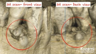 Diagnosis and Surgical Removal of Supernumerary Teeth In a 7-Year Old ...