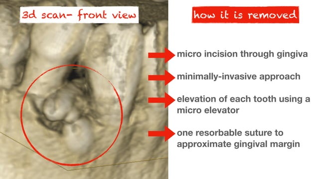 Diagnosis and Surgical Removal of Supernumerary Teeth In a 7-Year Old ...