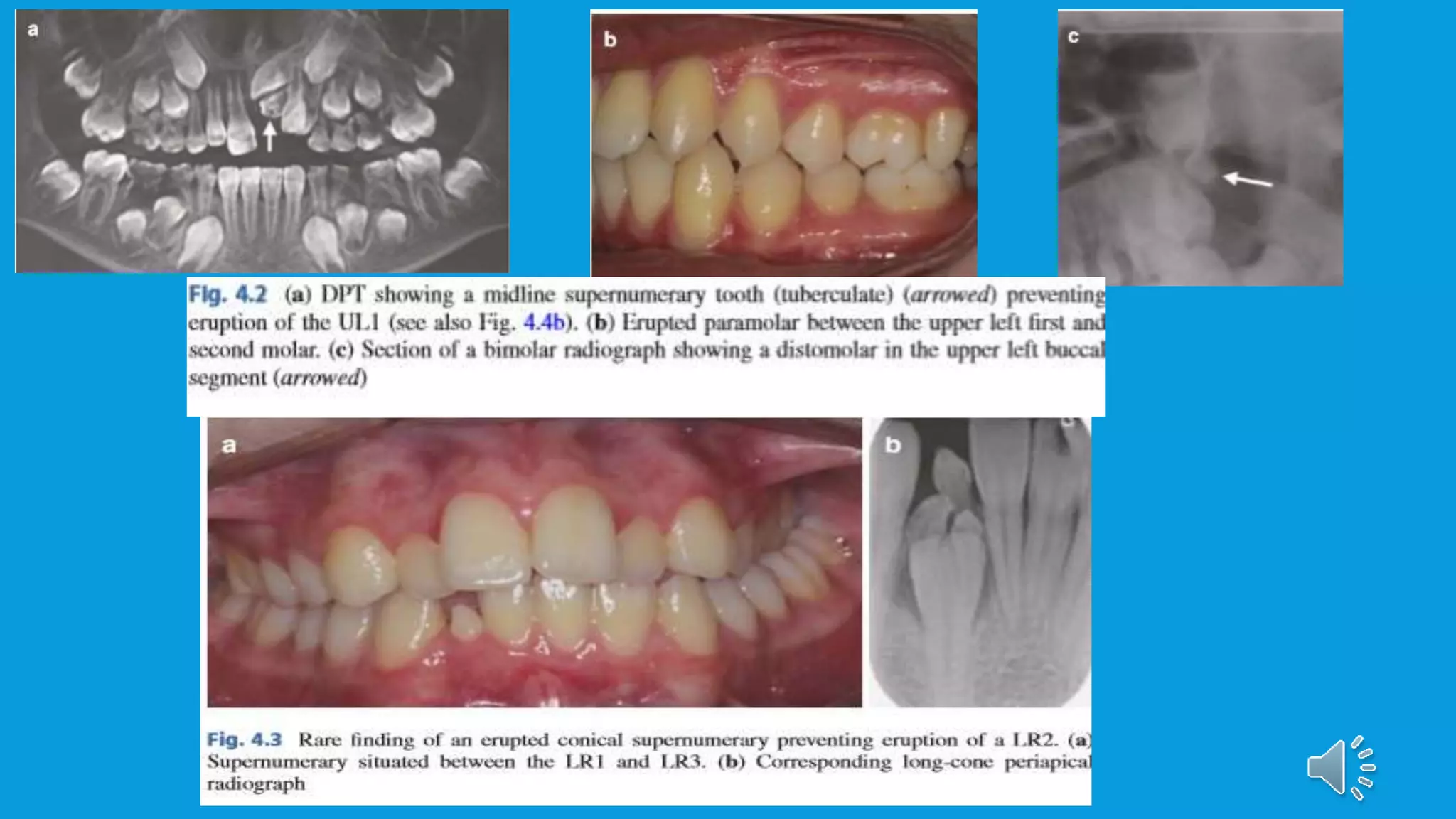 Supernumerary teeth fifth-year second semester | PPTX