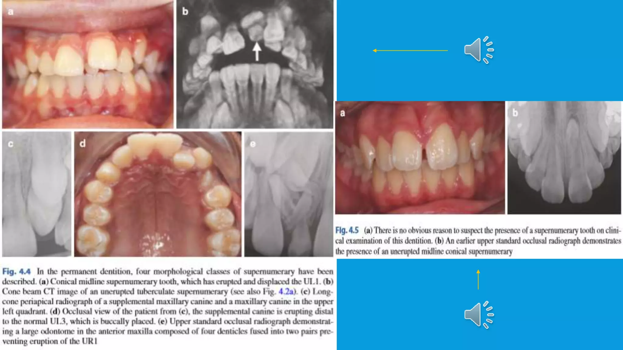 Supernumerary teeth fifth-year second semester | PPTX