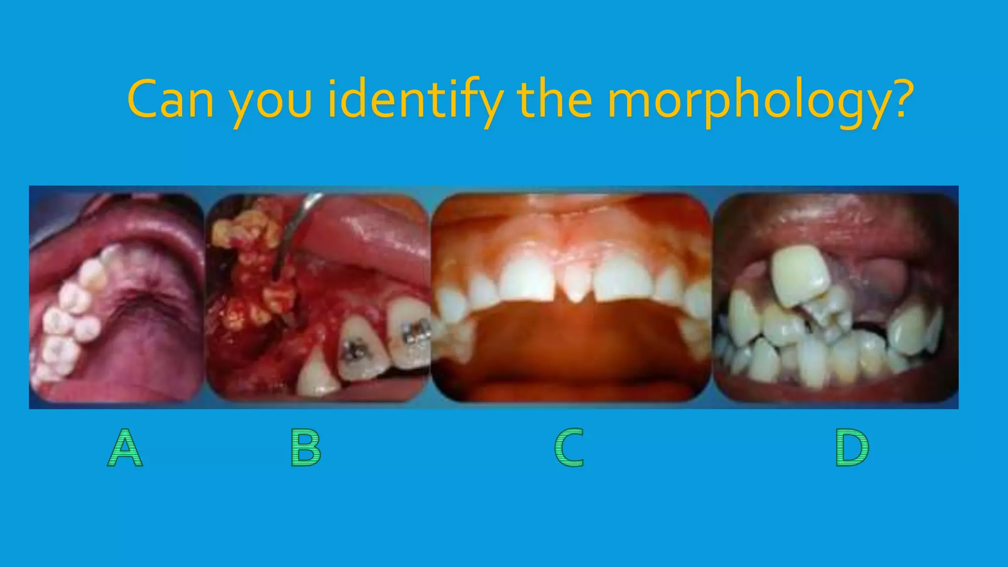 Supernumerary teeth fifth-year second semester | PPTX