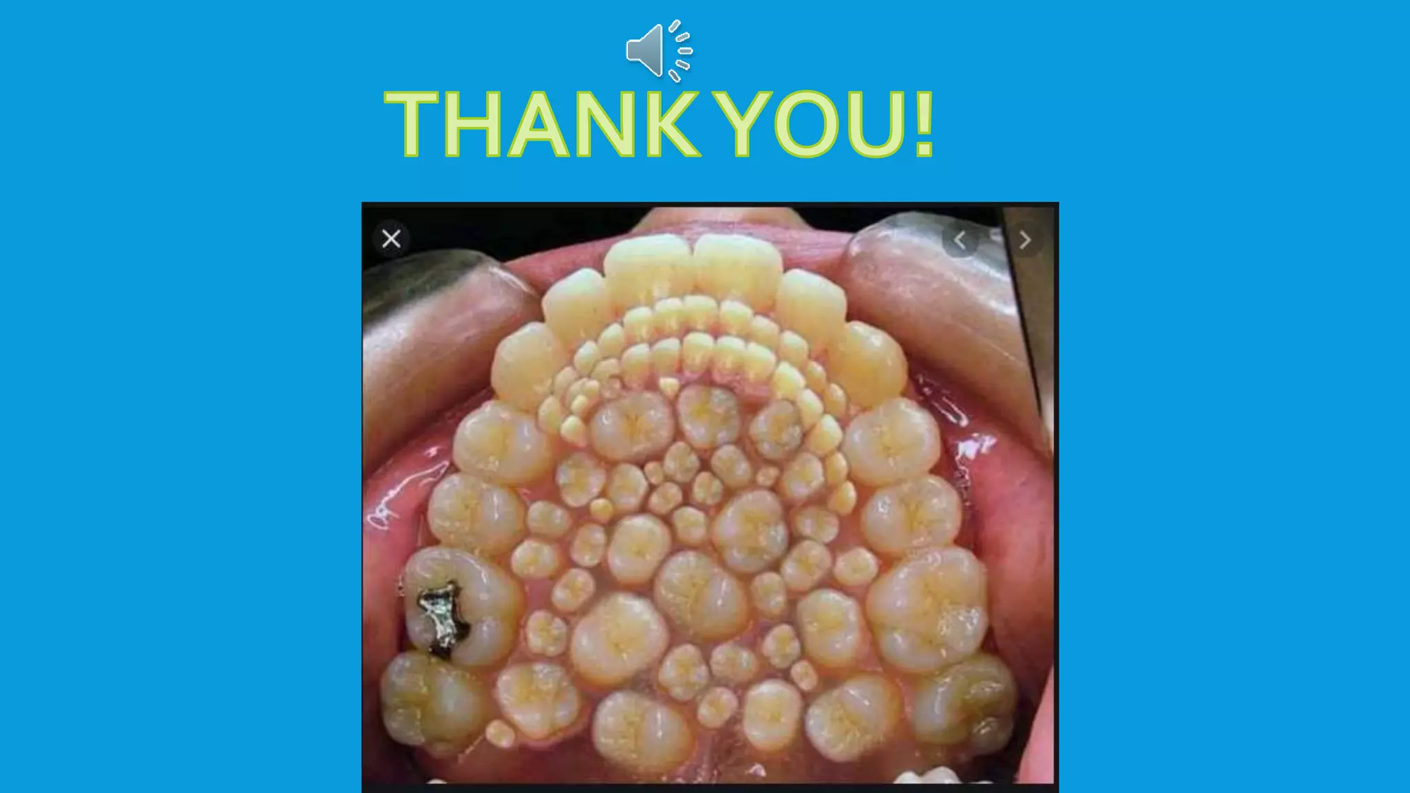 Supernumerary teeth fifth-year second semester | PPTX