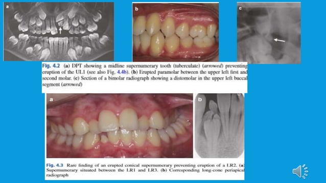 Supernumerary teeth fifth-year second semester | PPTX