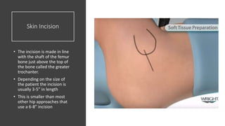 Super path hip replacement | PPTX