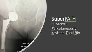 Super path hip replacement | PPTX