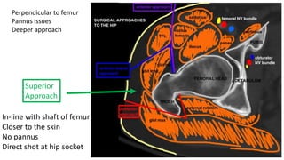 Super path hip replacement | PPTX