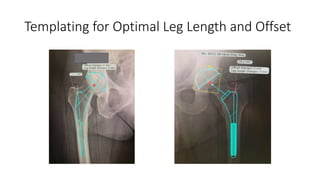 Super path hip replacement | PPTX