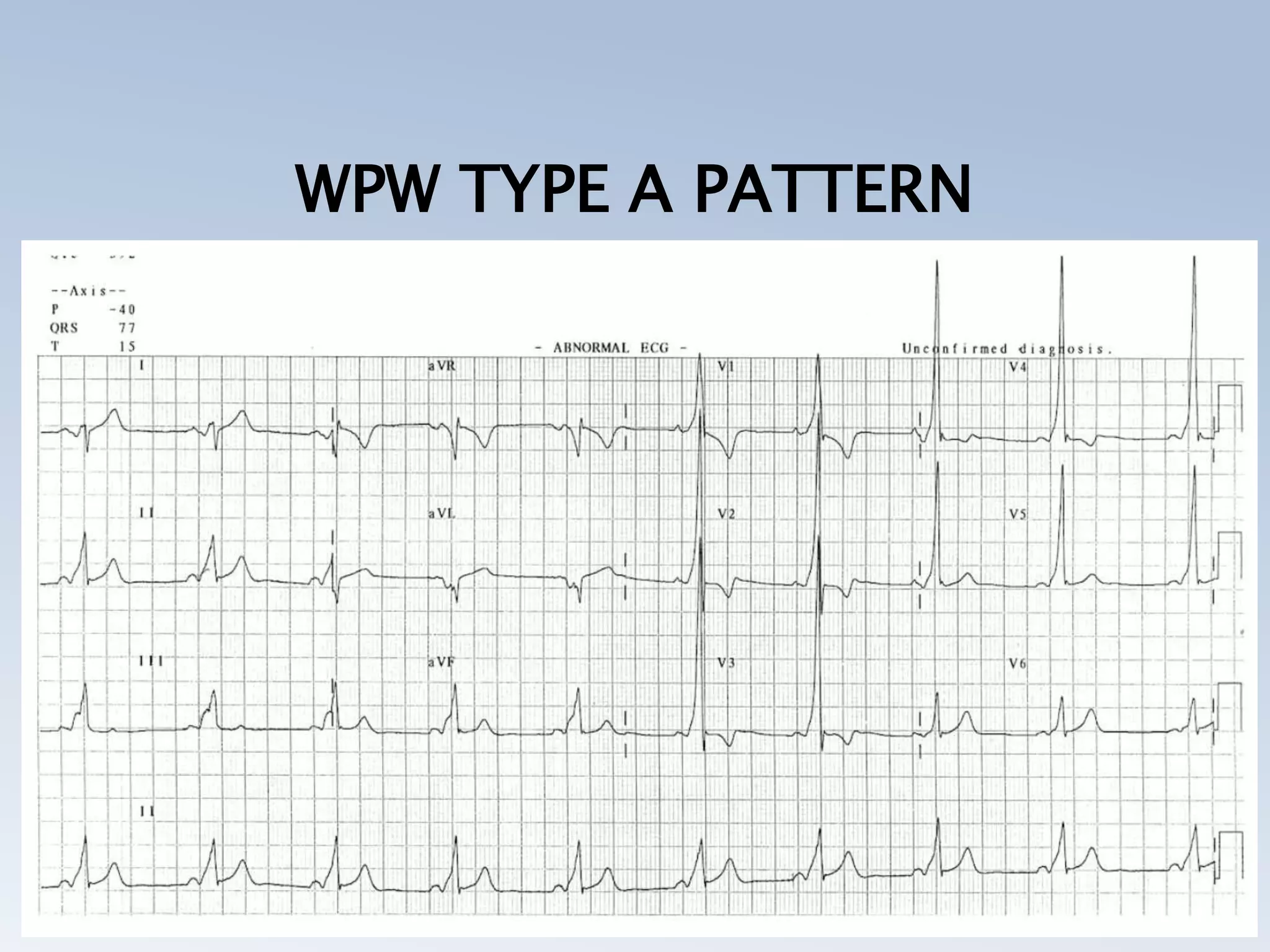 PRE EXCITATION SYNDROMES (THE WOLFF PARKINSON WHITE, LPL, MAHAIM) | PPTX