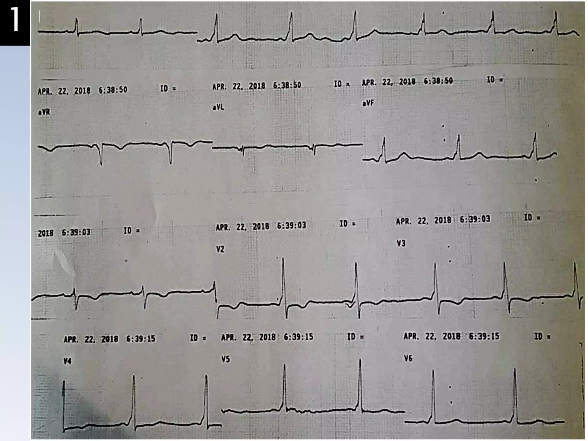 PRE EXCITATION SYNDROMES (THE WOLFF PARKINSON WHITE, LPL, MAHAIM) | PPTX