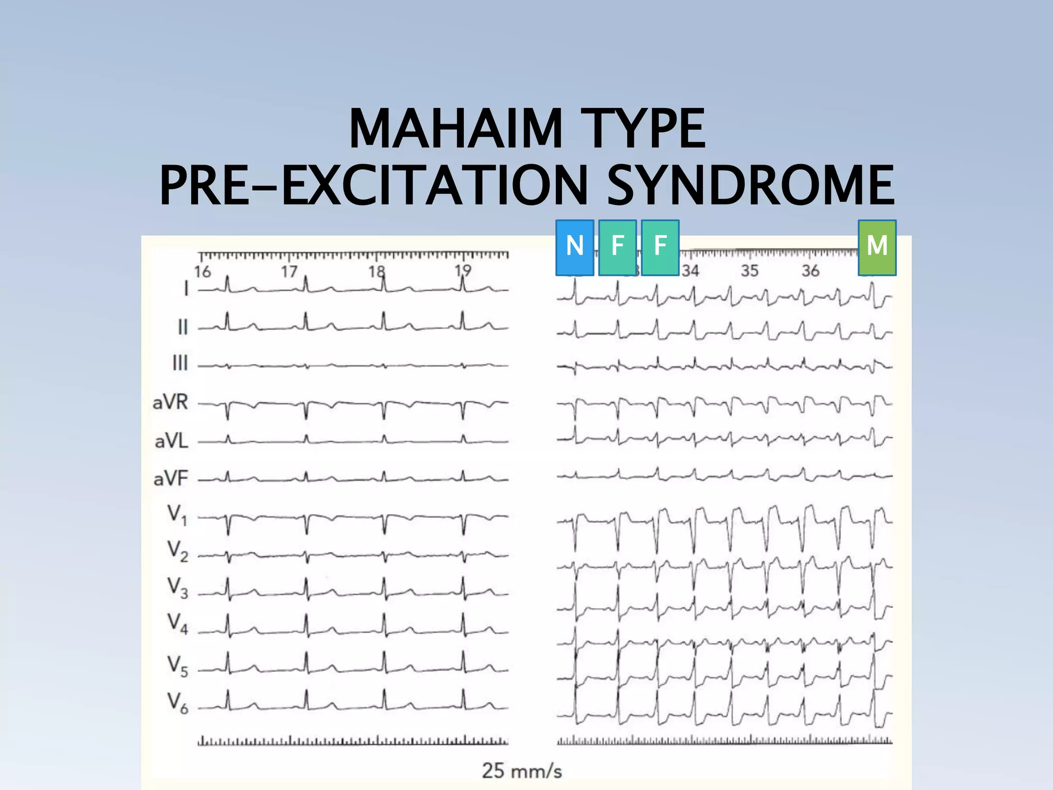 PRE EXCITATION SYNDROMES (THE WOLFF PARKINSON WHITE, LPL, MAHAIM) | PPTX