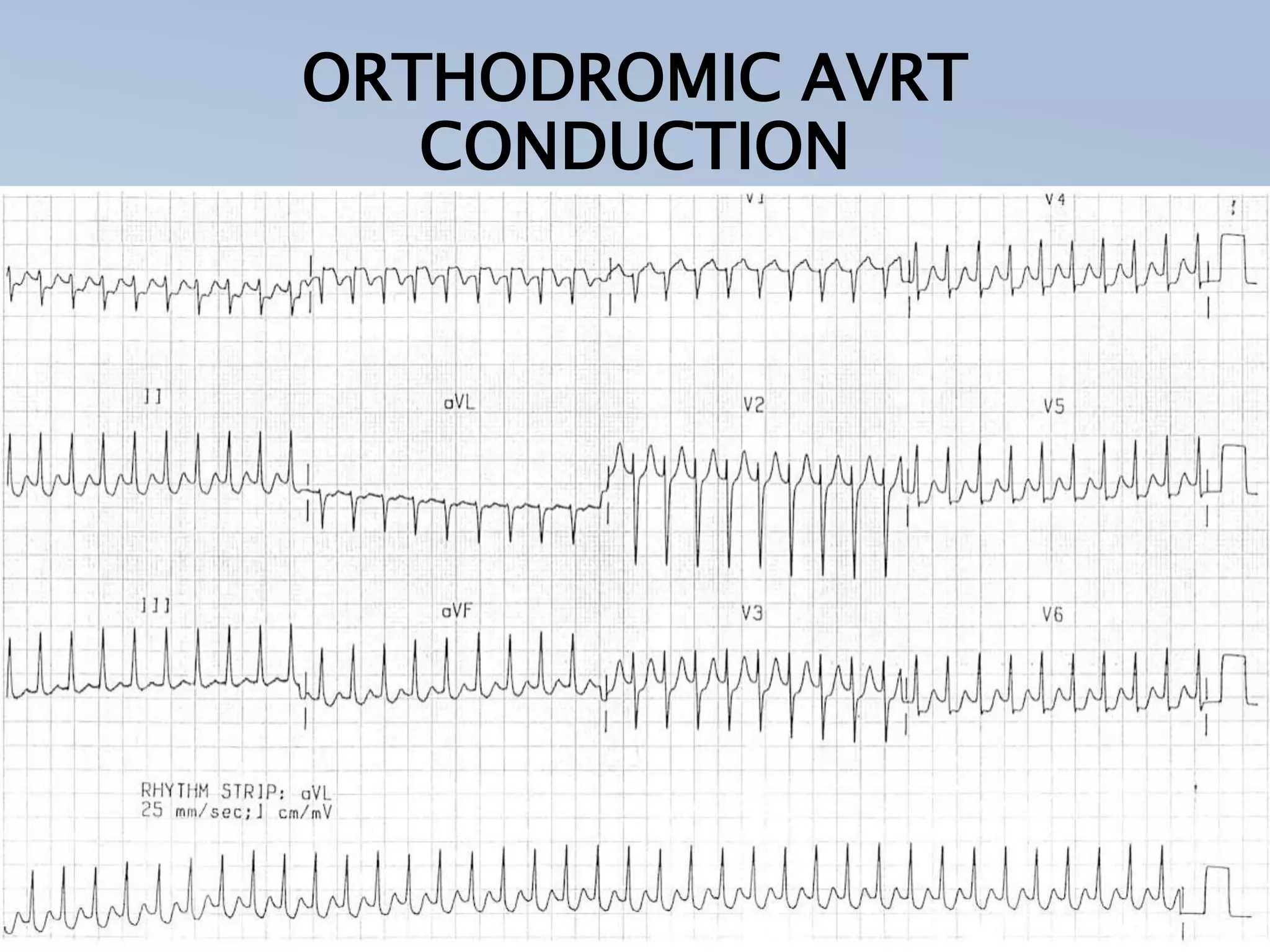 PRE EXCITATION SYNDROMES (THE WOLFF PARKINSON WHITE, LPL, MAHAIM) | PPTX