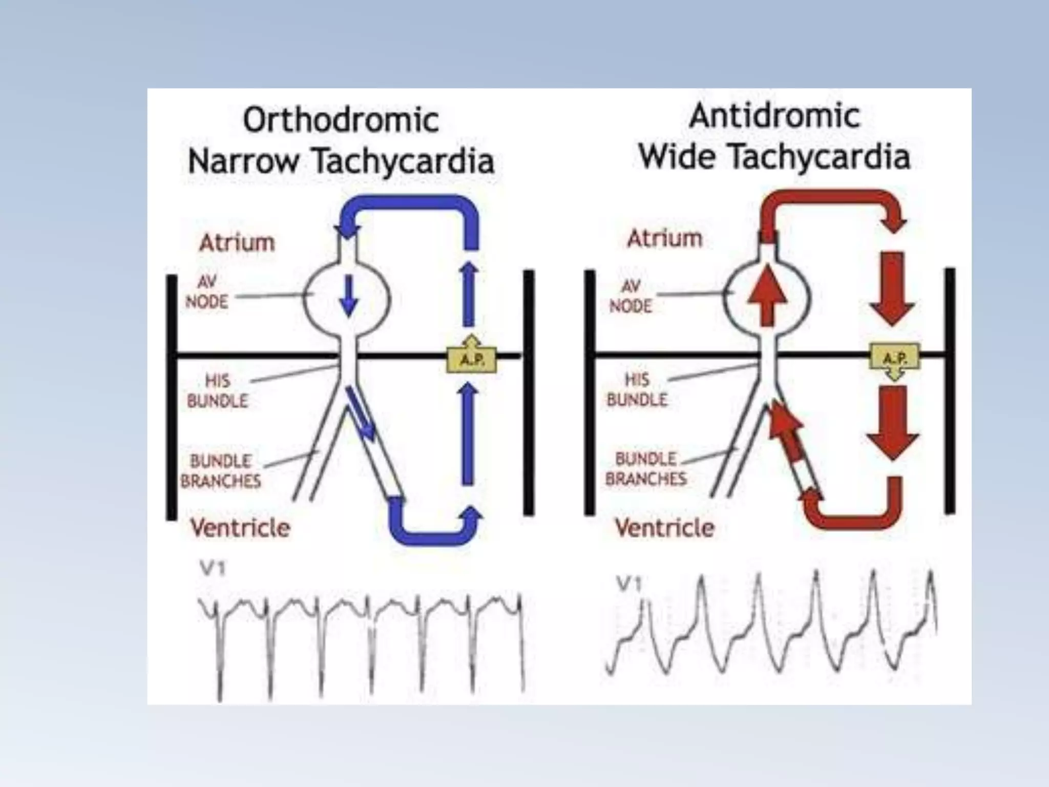PRE EXCITATION SYNDROMES (THE WOLFF PARKINSON WHITE, LPL, MAHAIM) | PPTX