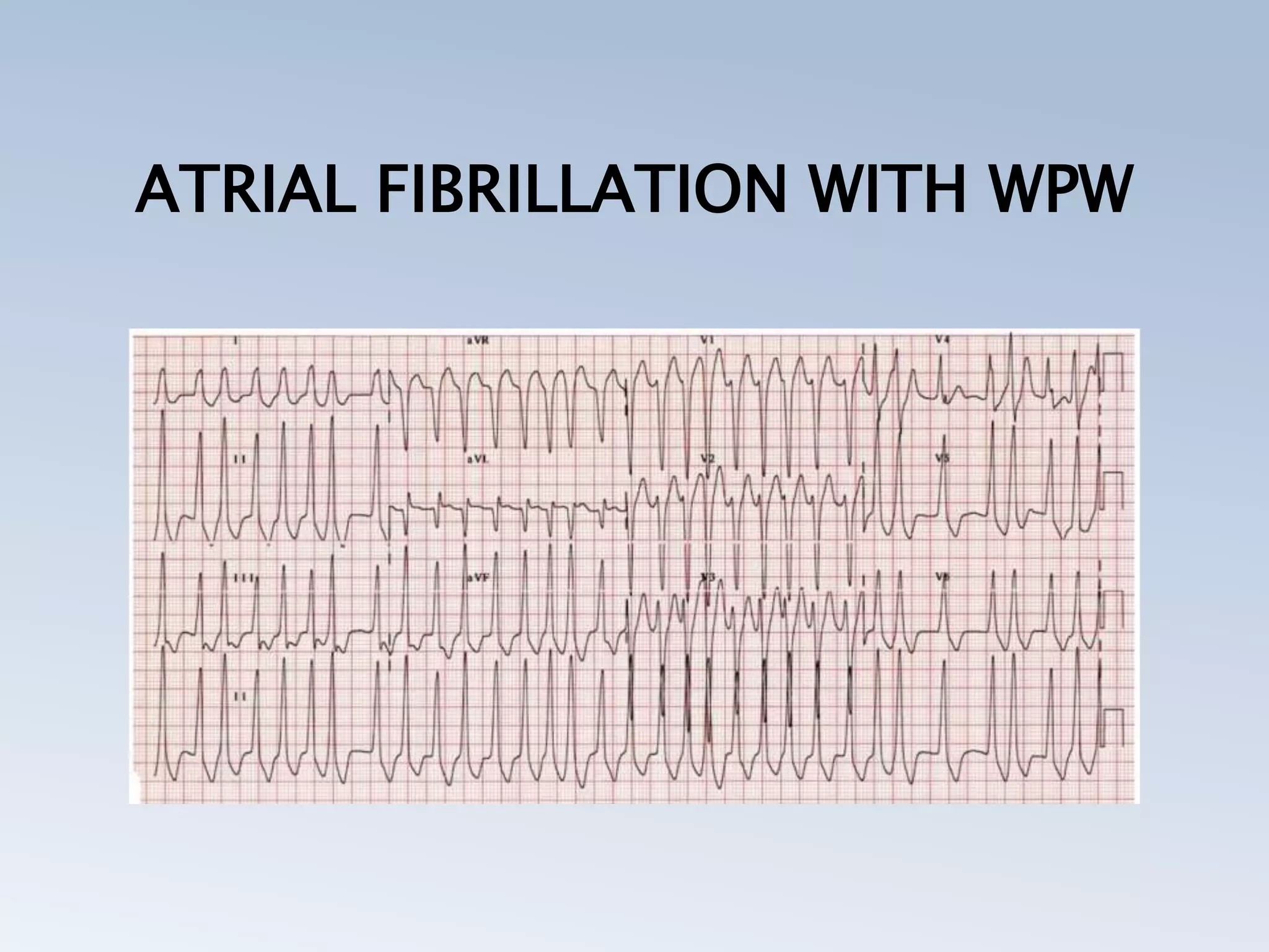 PRE EXCITATION SYNDROMES (THE WOLFF PARKINSON WHITE, LPL, MAHAIM) | PPTX