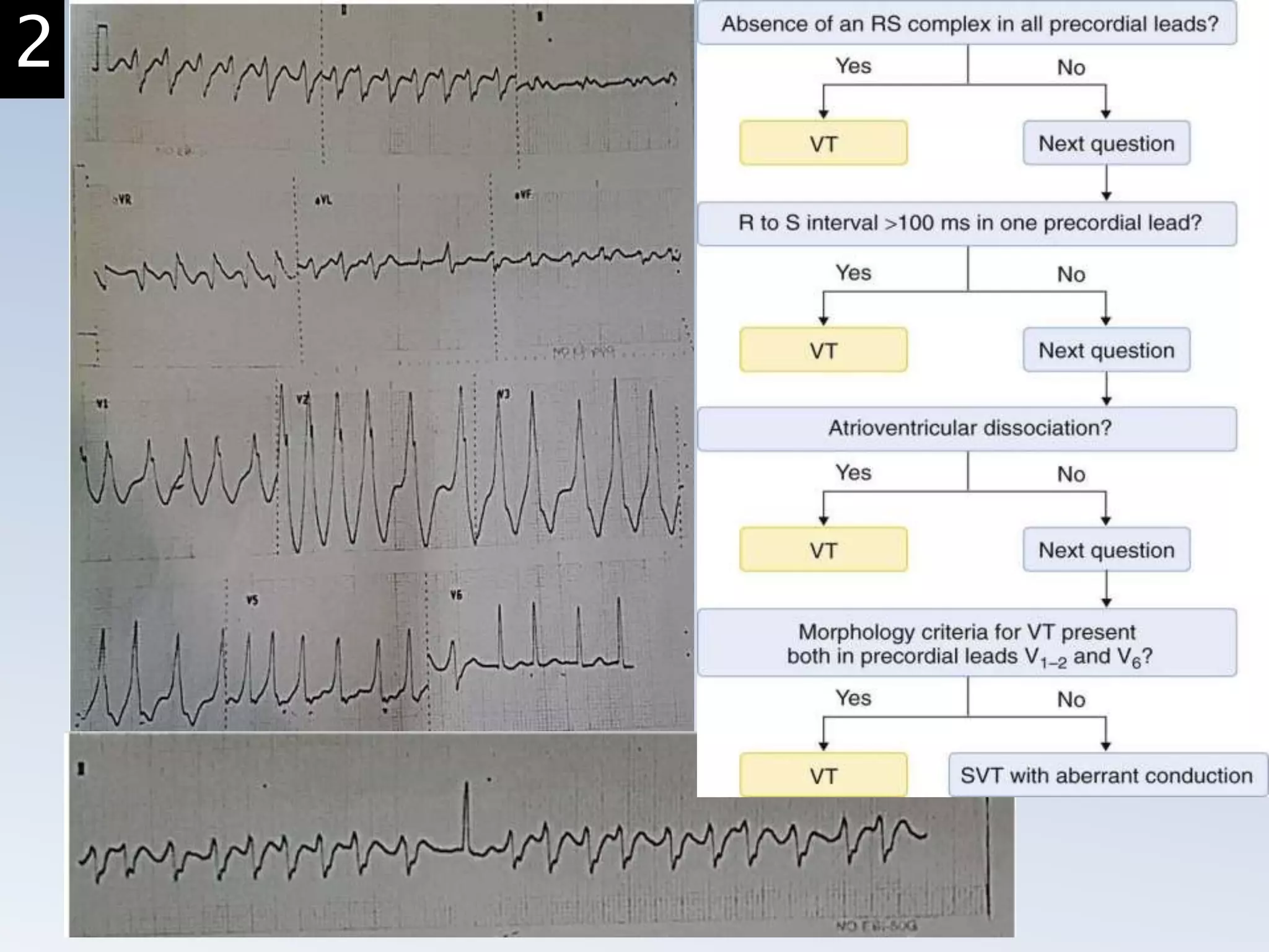 PRE EXCITATION SYNDROMES (THE WOLFF PARKINSON WHITE, LPL, MAHAIM) | PPTX