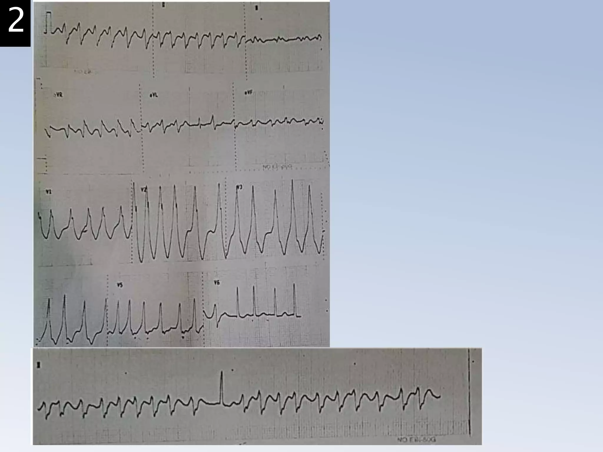 PRE EXCITATION SYNDROMES (THE WOLFF PARKINSON WHITE, LPL, MAHAIM) | PPTX