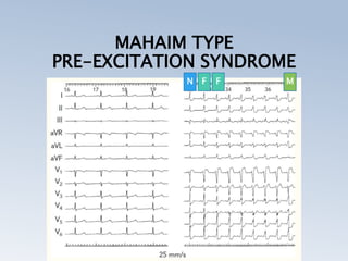 PRE EXCITATION SYNDROMES (THE WOLFF PARKINSON WHITE, LPL, MAHAIM) | PPTX