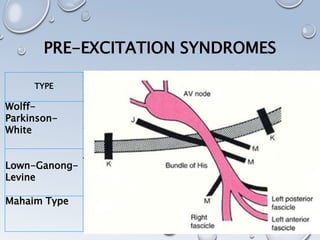PRE EXCITATION SYNDROMES (THE WOLFF PARKINSON WHITE, LPL, MAHAIM) | PPTX