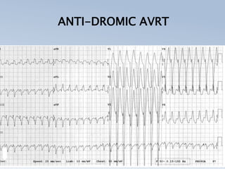 PRE EXCITATION SYNDROMES (THE WOLFF PARKINSON WHITE, LPL, MAHAIM) | PPTX