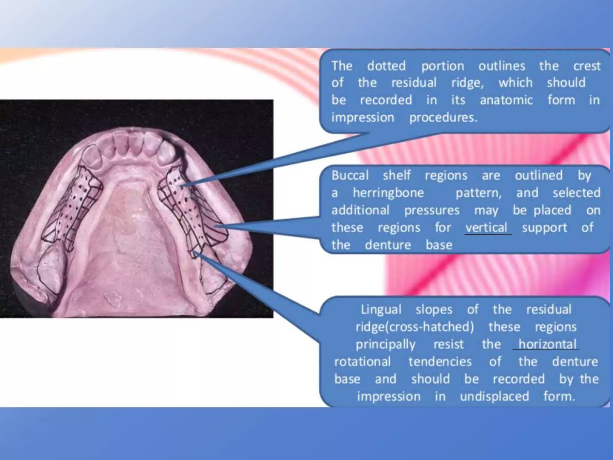 support for distal extension bases.ppt