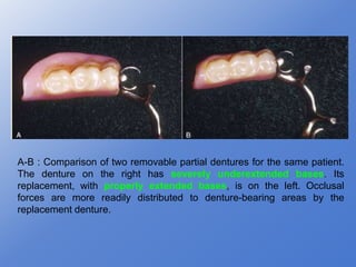 support for distal extension bases.ppt