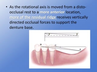support for distal extension bases.ppt