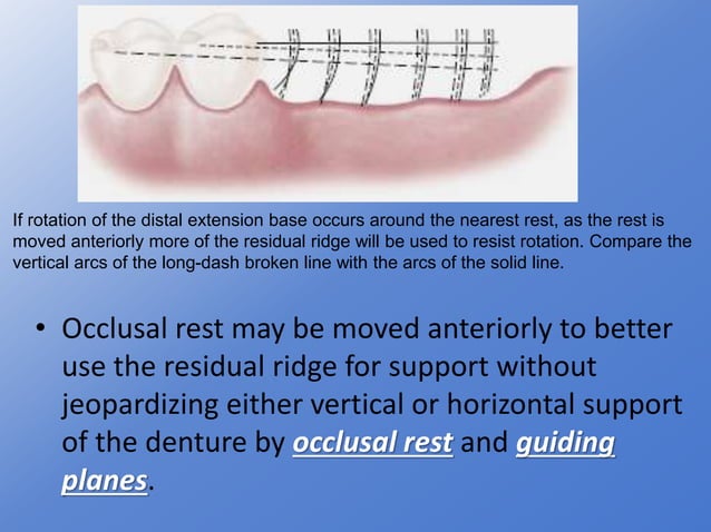 support for distal extension bases.ppt
