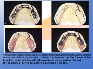 support for distal extension bases.ppt