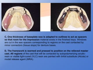 support for distal extension bases.ppt