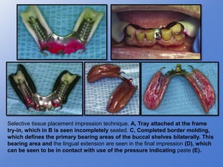 support for distal extension bases.ppt