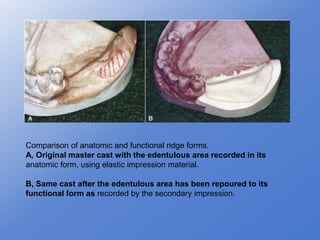 support for distal extension bases.ppt