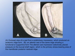 support for distal extension bases.ppt