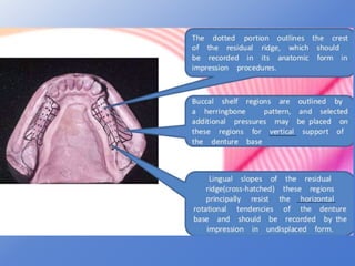support for distal extension bases.ppt