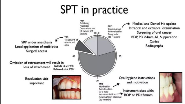 SUPPORTIVE PERIODONTAL THERAPY and maintenance period | PPT