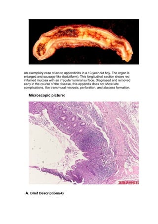 Suppurative Inflammation | DOC