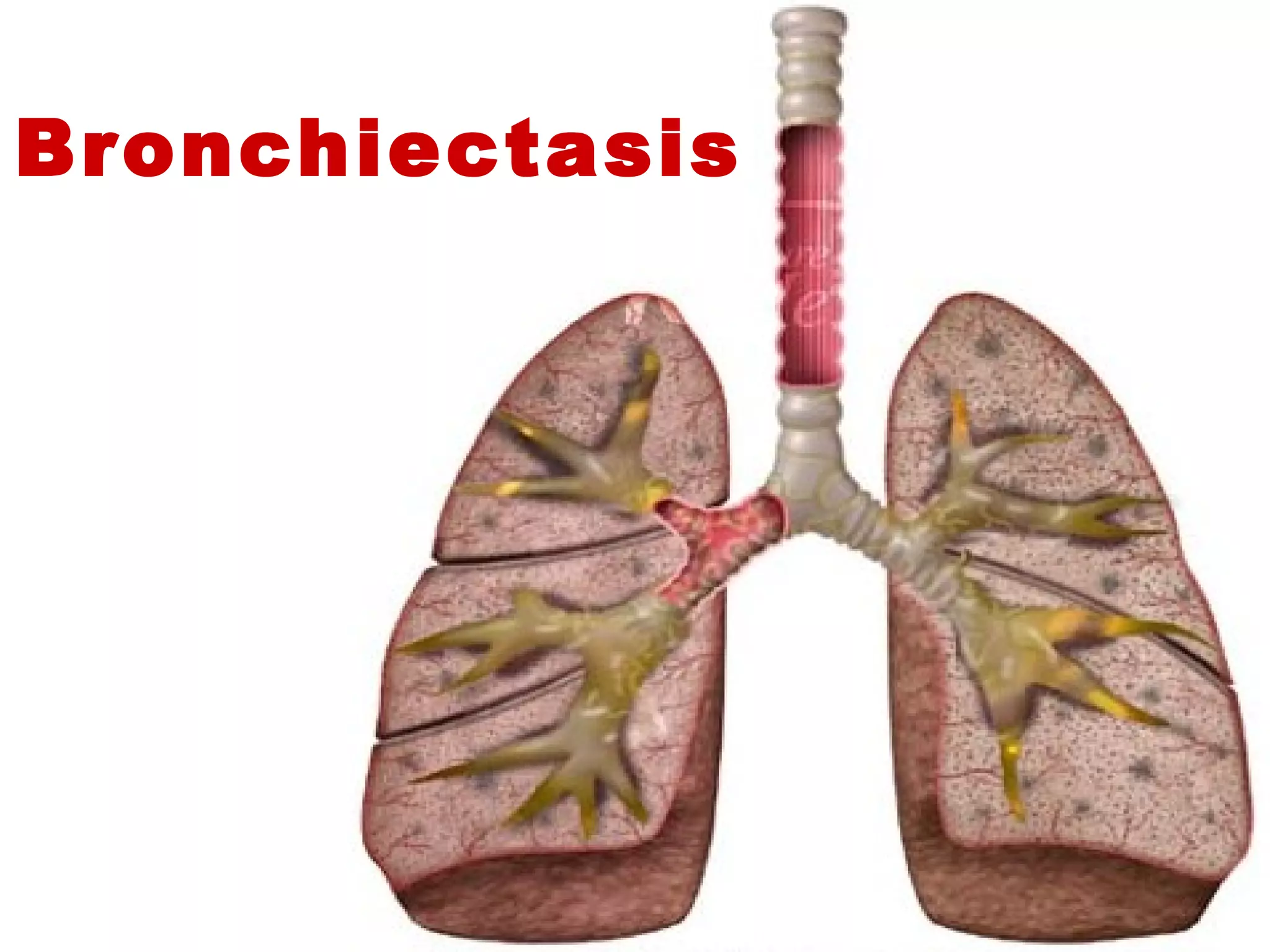 Suppurative lung diseases | PPT