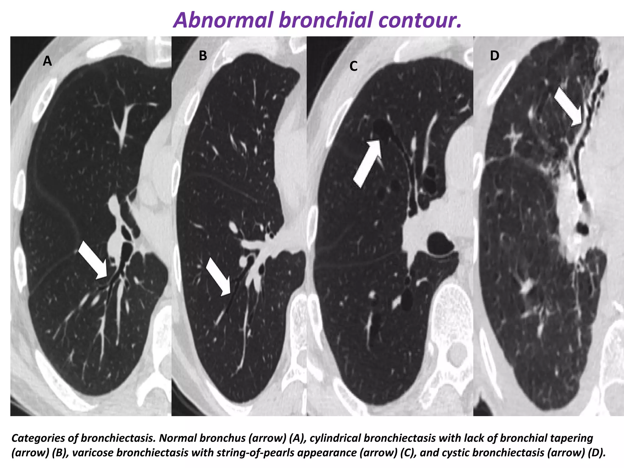 Suppurative lung diseases | PPT