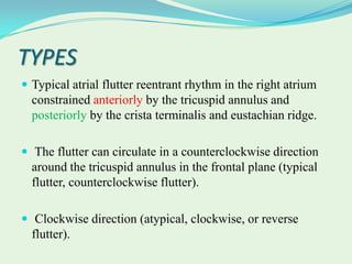 Supra ventricular tachycardia | PPTX