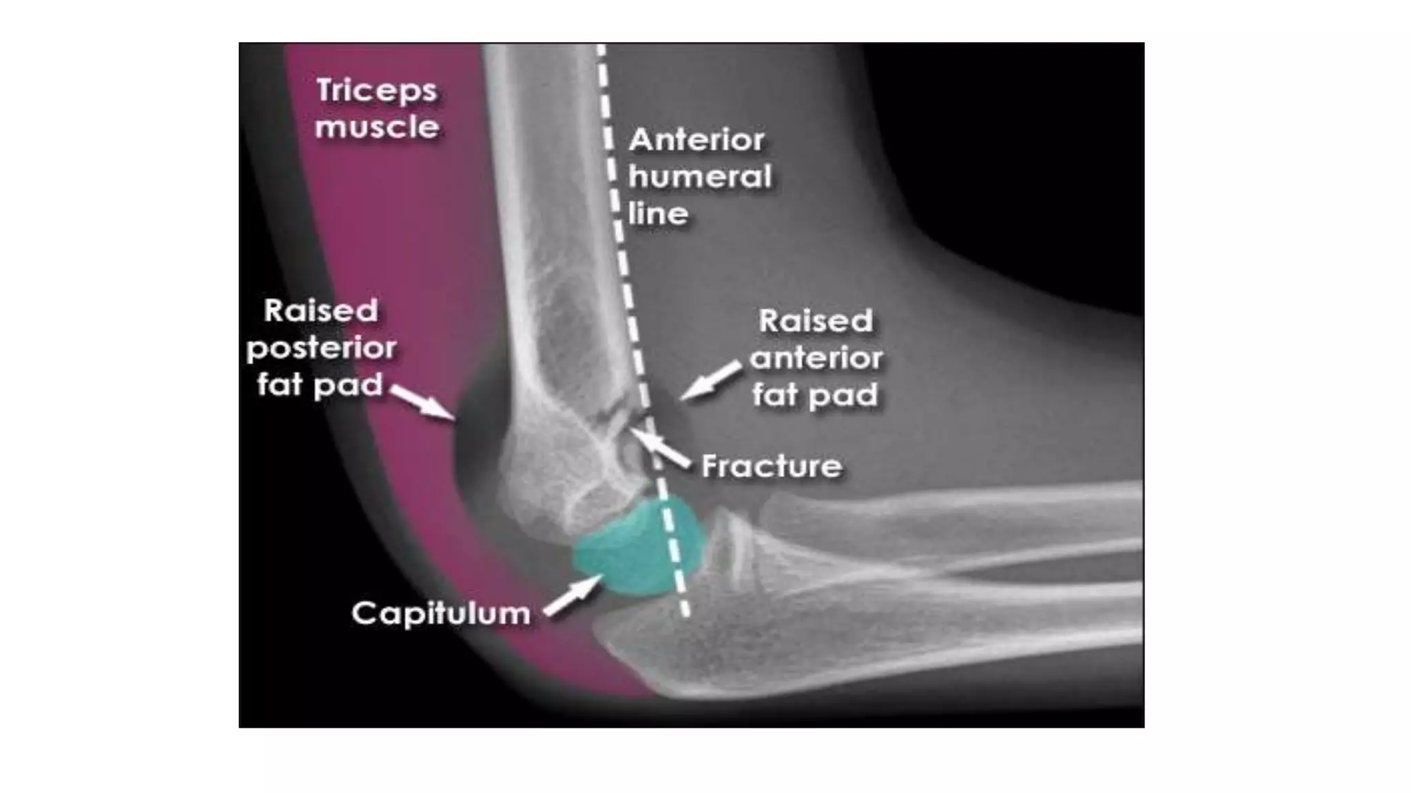 Supra condylar fracture | PPTX